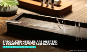Persistent Back Pain? Time to Try Acupuncture! | Oriole Physiotherapy ...